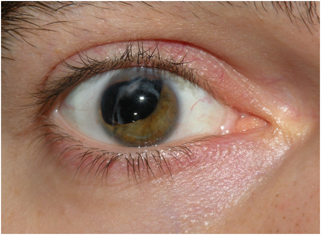 First Aid for Eye Injuries: How to Address Different Eye Emergencies