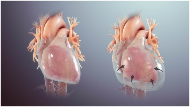 Why You Might Have Fluid Around Your Heart – And What To Do About It